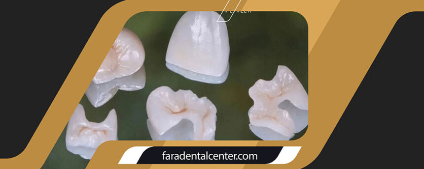 Composite Inlay and Onlay Filling Applications – Fara