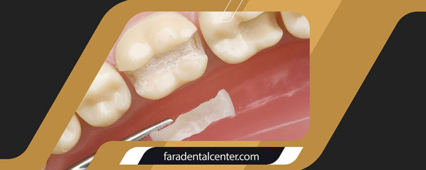 Porcelain Filling - Fara